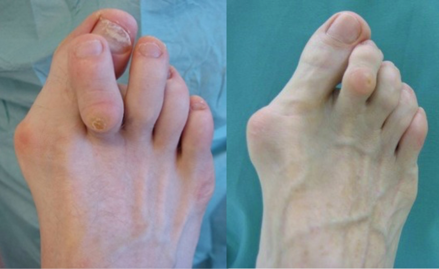Hallux Valgus Treatment and Recovery > Sincerus Orthopaedics ...
